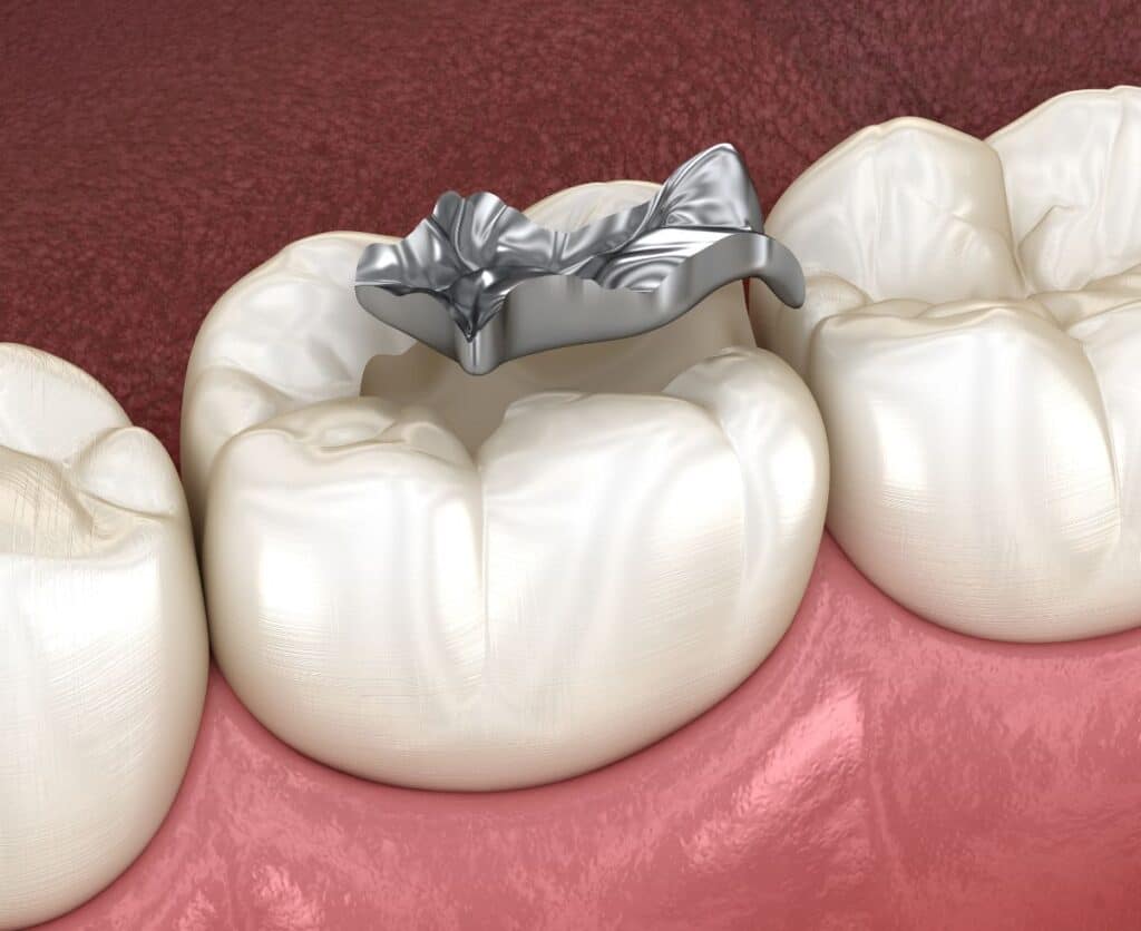 Amalgam Fillings - Hastings Dental Center