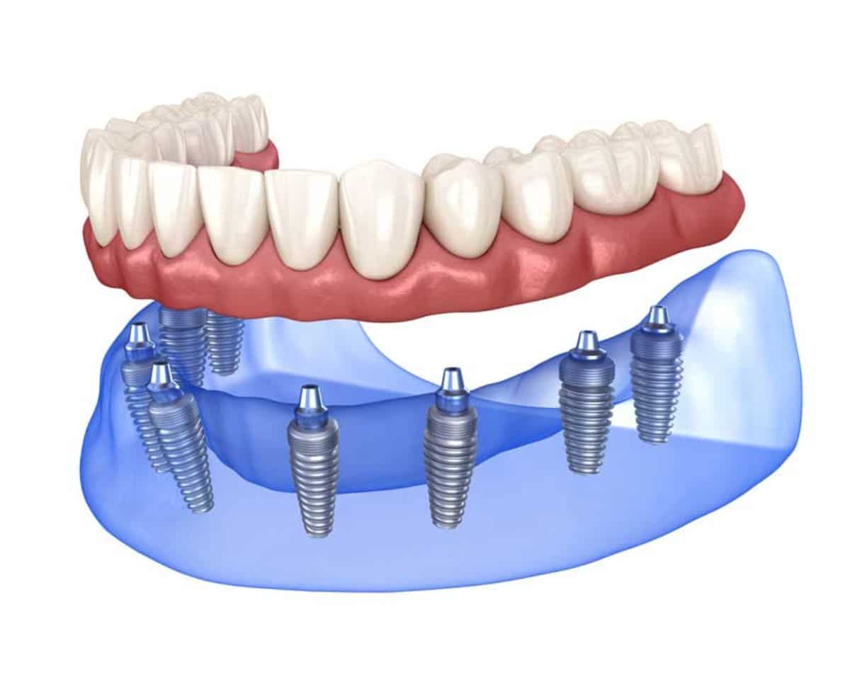 Full Arch Replacement – Hastings Dental Center