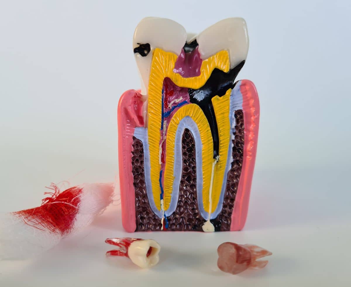 Root Amputation - Hastings Dental Center